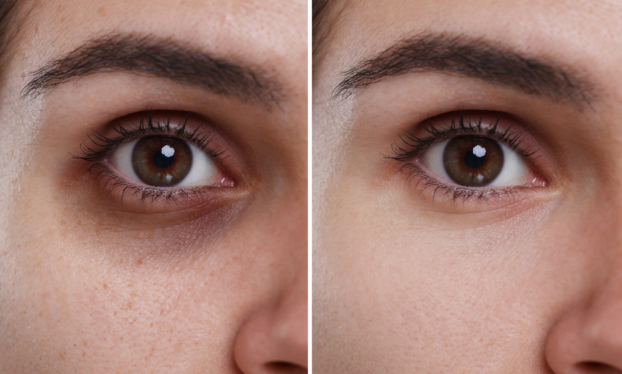 Get Rid of Dark Circles With PRP Facelift